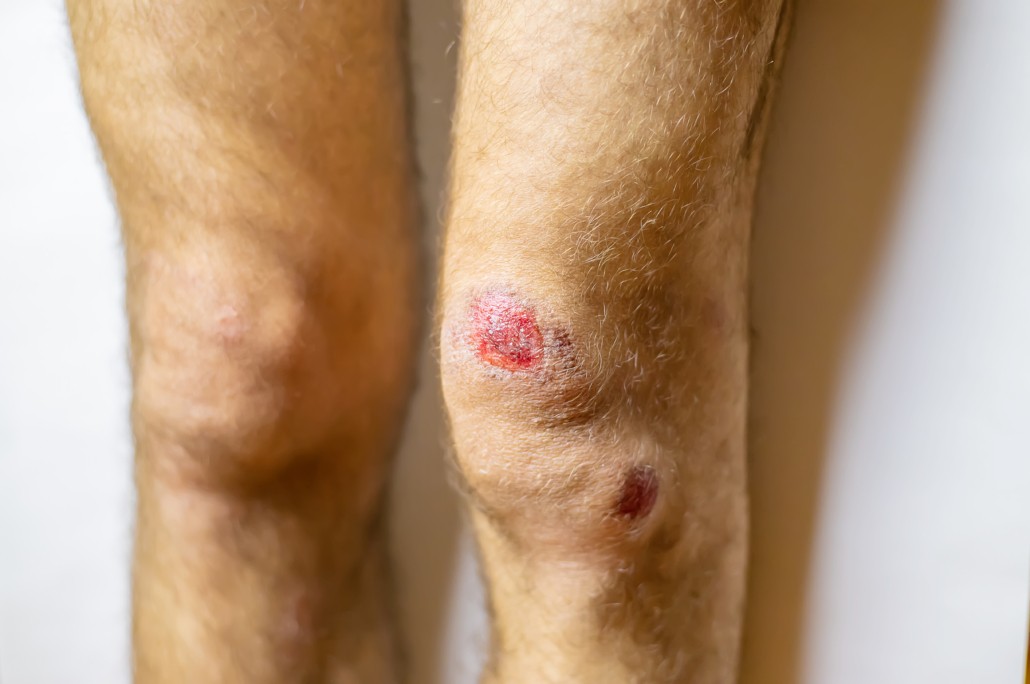 Venous Stasis Ulcers Treatment | Vincent Vein Center